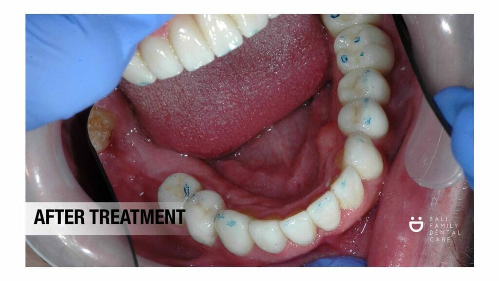 What Is Full Mouth Makeover and Should You Get One? – Bali Family ...
