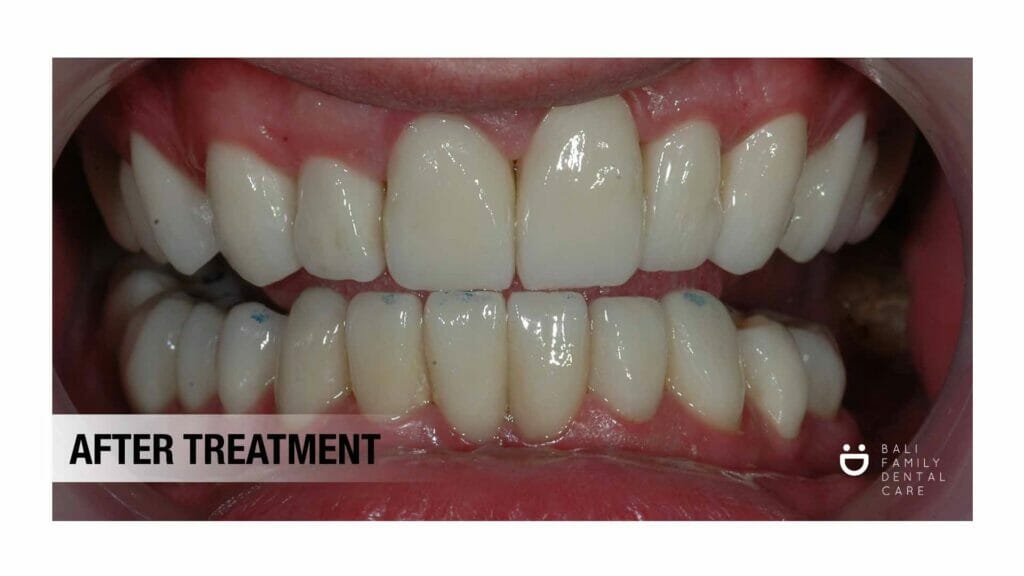 What Is Full Mouth Makeover and Should You Get One? - Bali Family ...