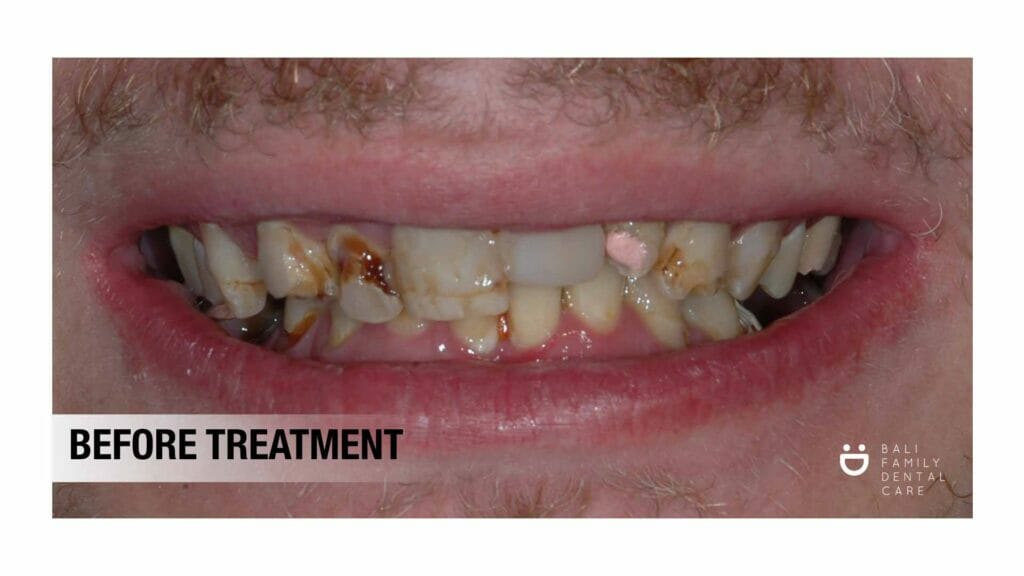 What Is Full Mouth Makeover and Should You Get One? – Bali Family ...