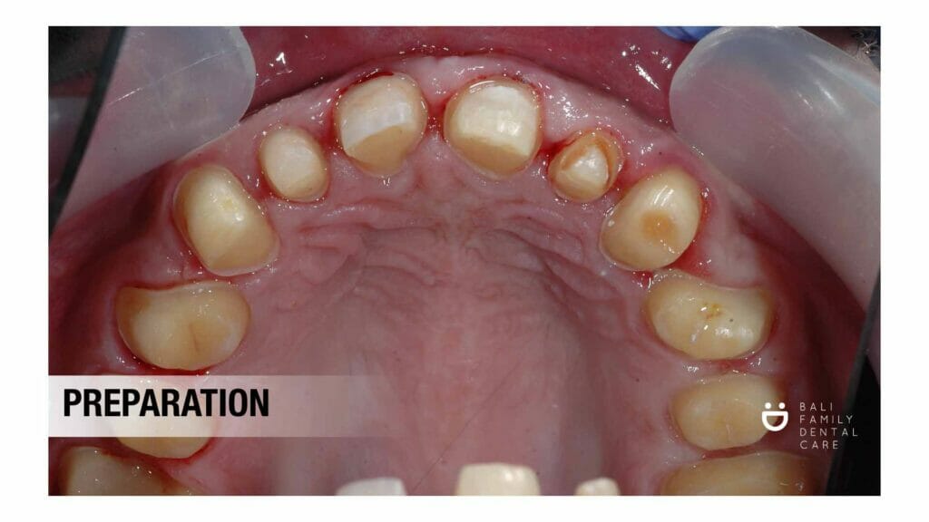 What Is Full Mouth Makeover and Should You Get One? – Bali Family ...
