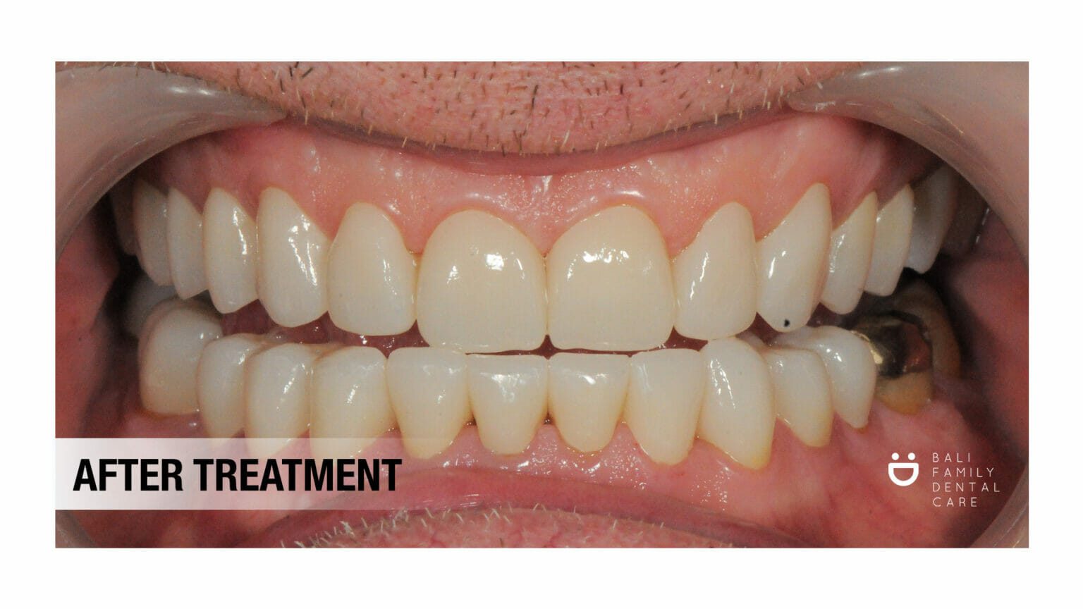 Porcelain Crown Restoration - Bali Family Dental Care