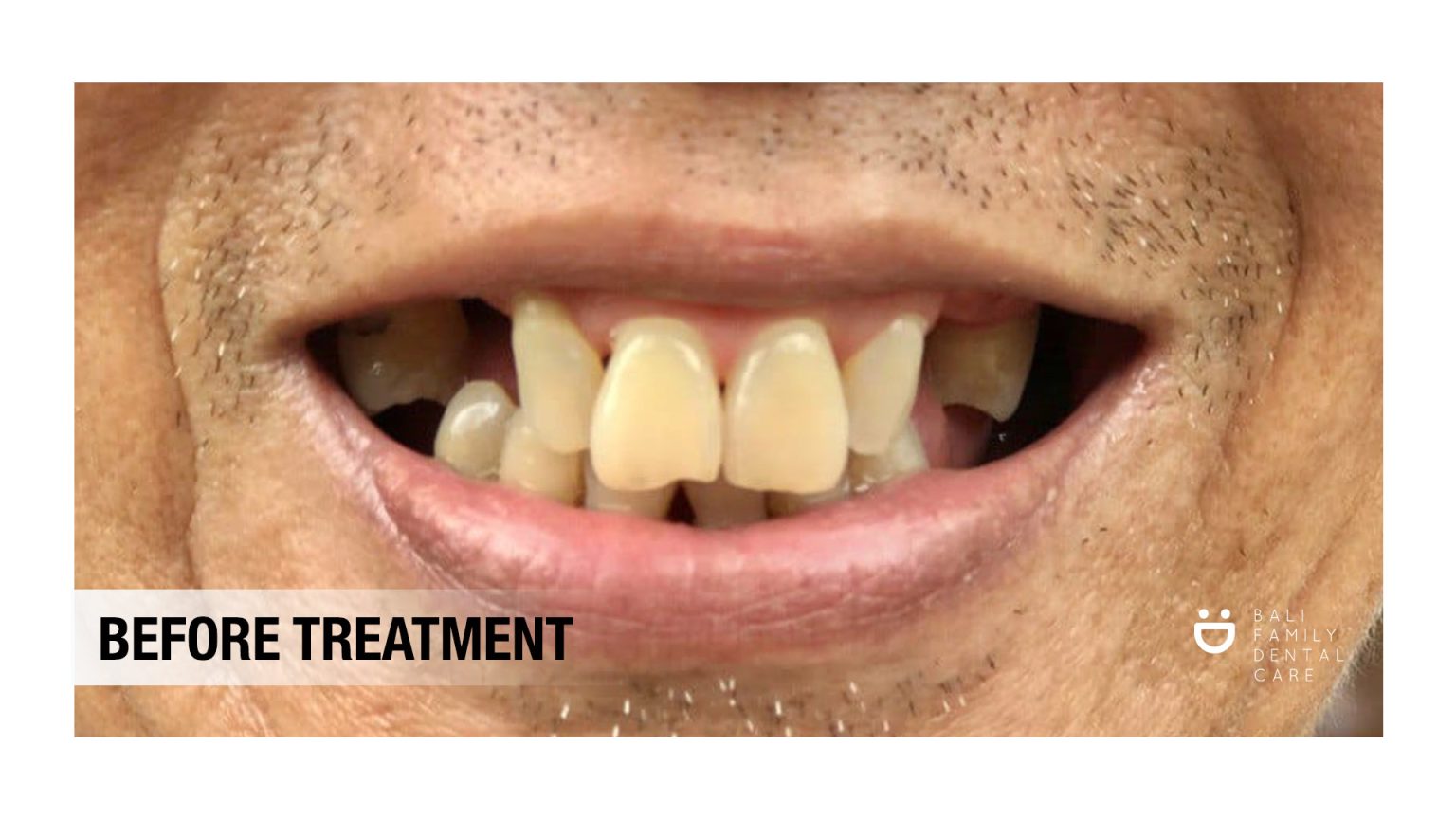 Dentures in Bali treatment - Bali Family Dental Care